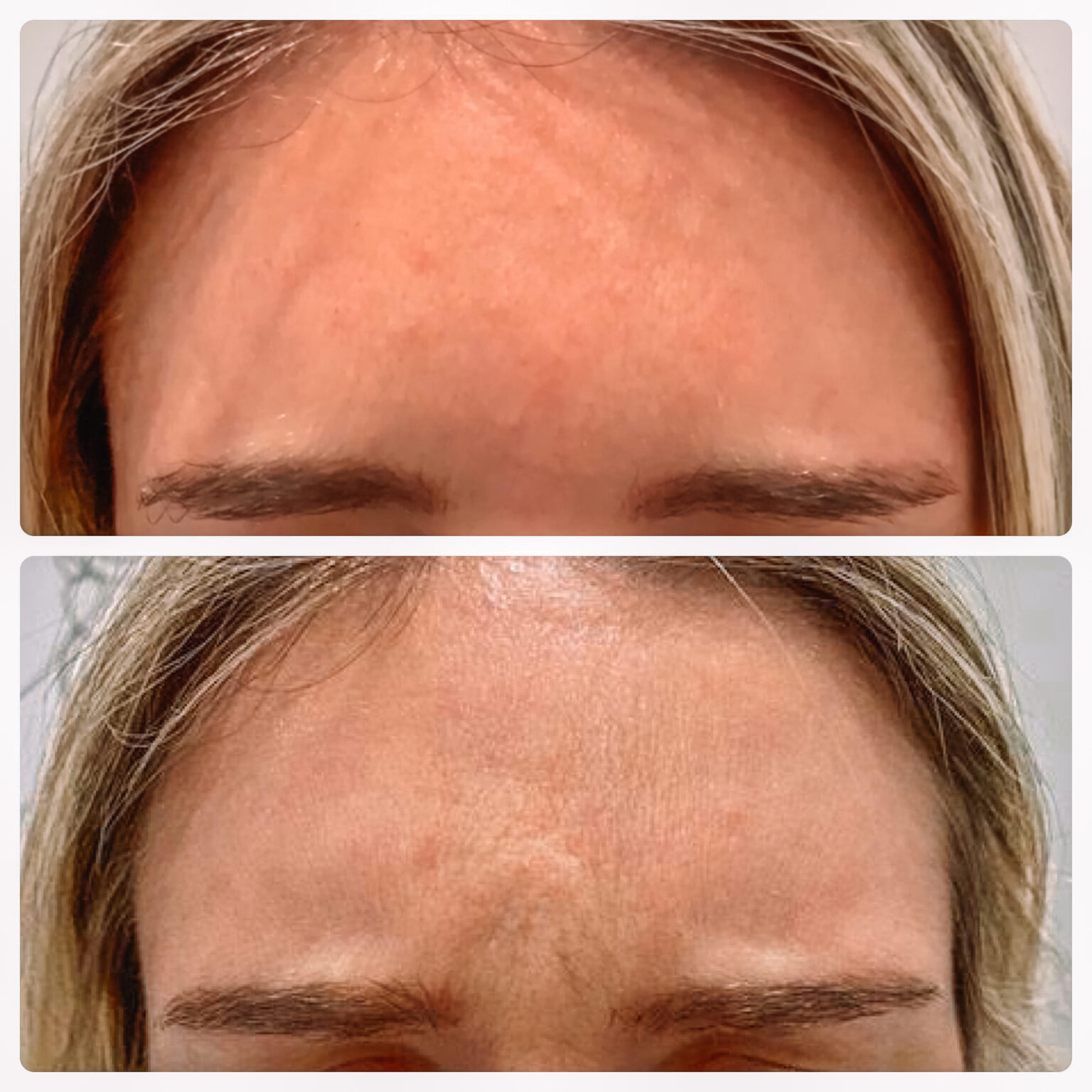 My Botox Experience; Everything You Need To Know! - Prada & Pearls